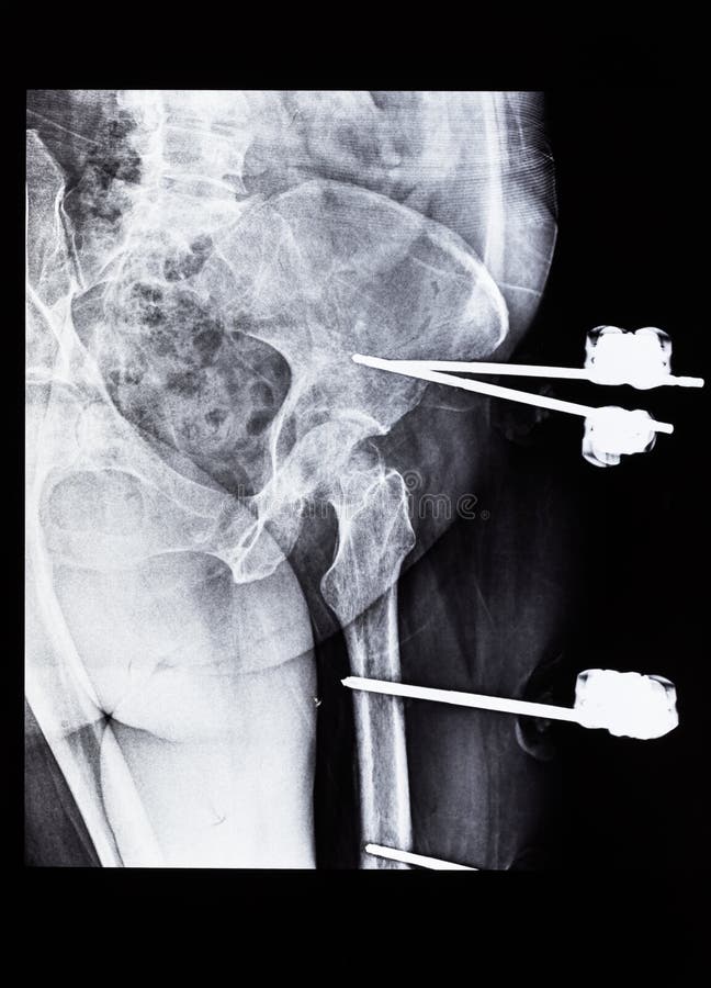 X-ray with External Fixation Device Fixed in Bones Stock Image - Image ...