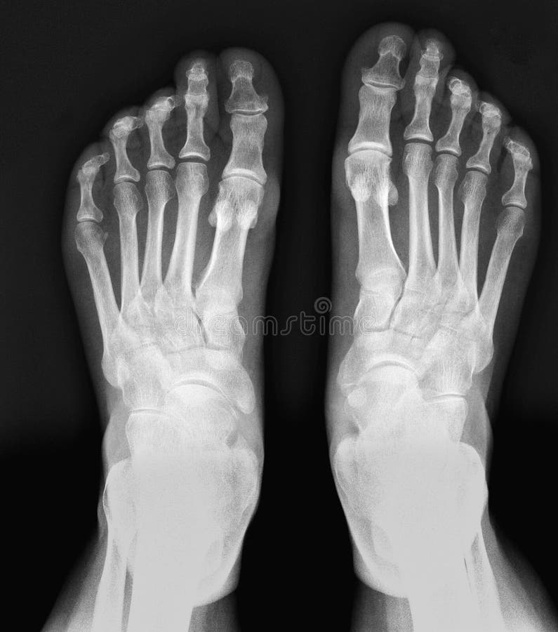 X-ray feet. stock photo. Image of treatment, medicine - 19391238