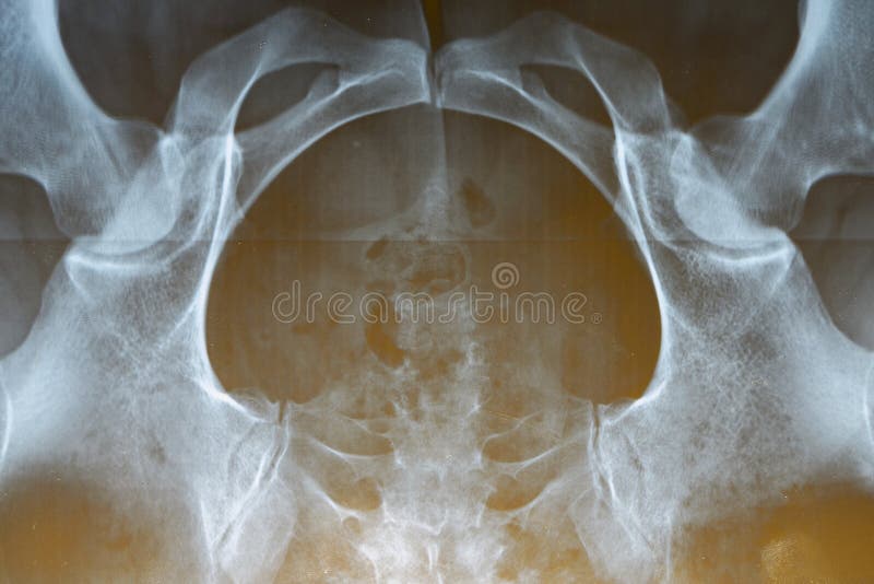 X-ray of the Female Hip Joint, Female Problems, Uterine and Ovarian ...