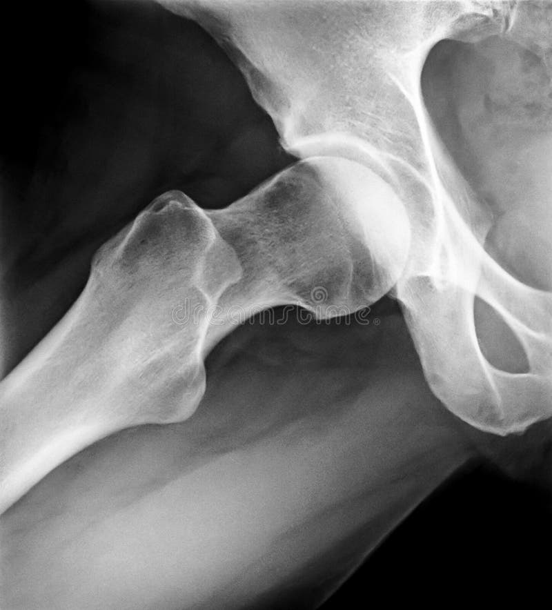 X-Ray of female Right Hip. stock photo. Image of orthopedic - 83692958