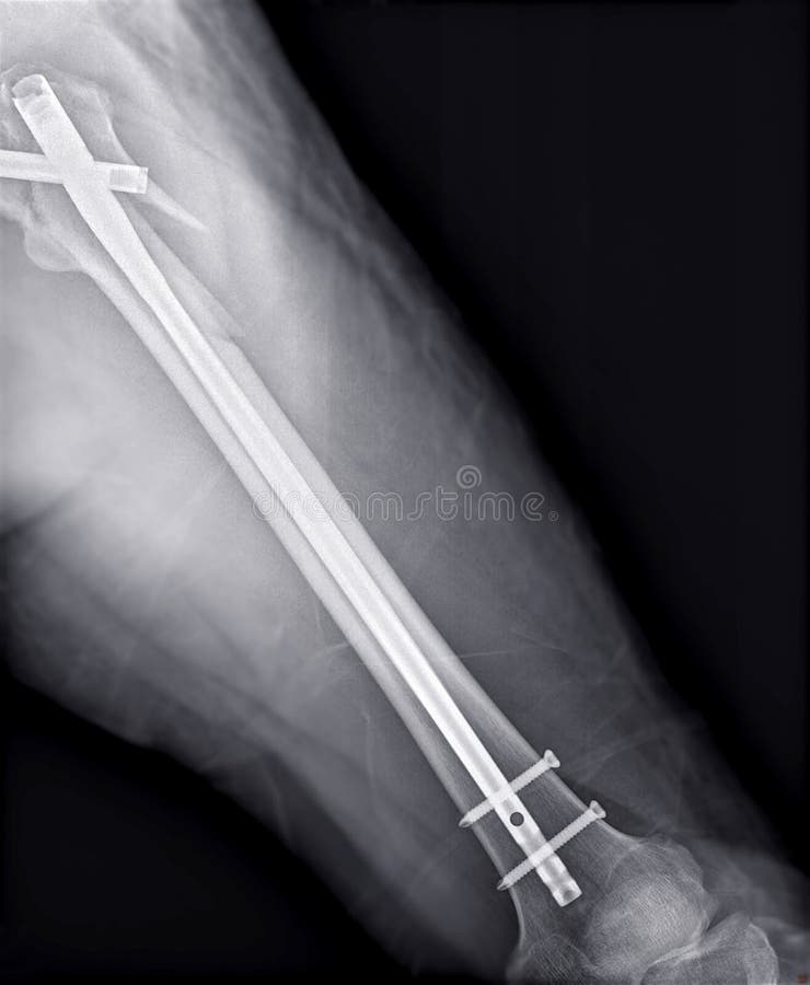 X-ray Femur Bone with Total Hip and Femur Replacement Stock Image ...