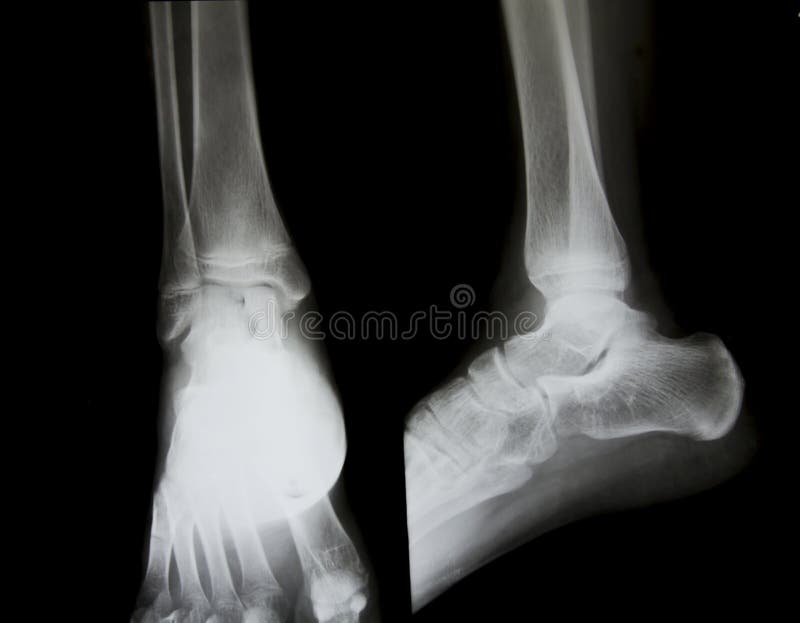 X-ray of both human legs stock photo. Image of clinical - 53766062