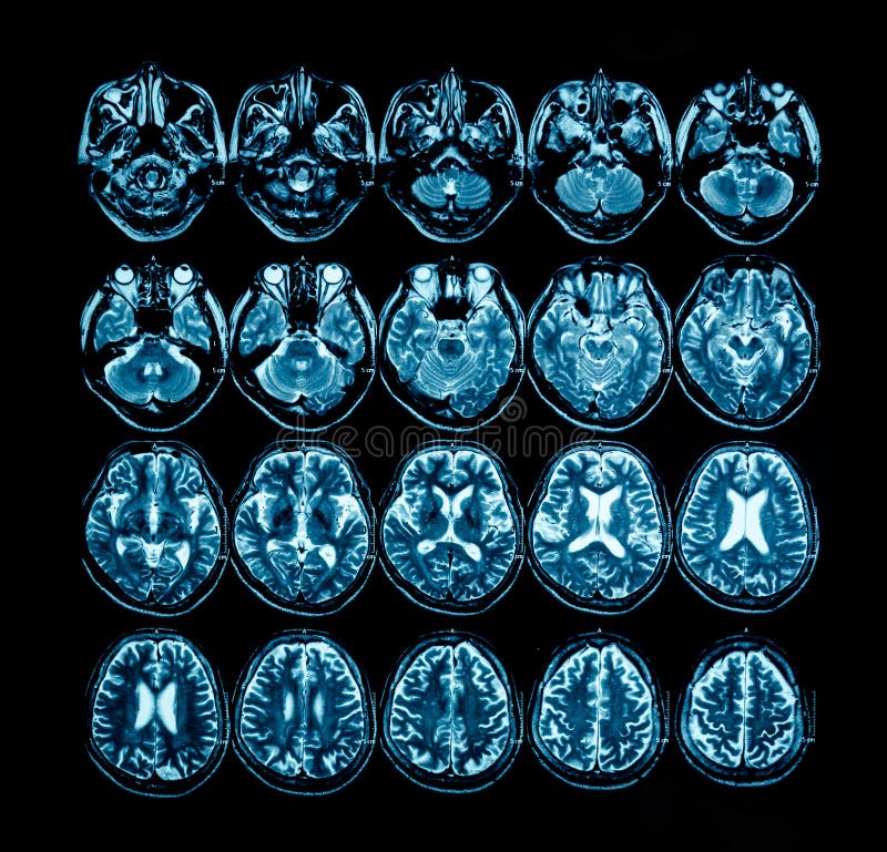 X-ray Film of the Brain Computed Tomography Stock Image - Image of ...