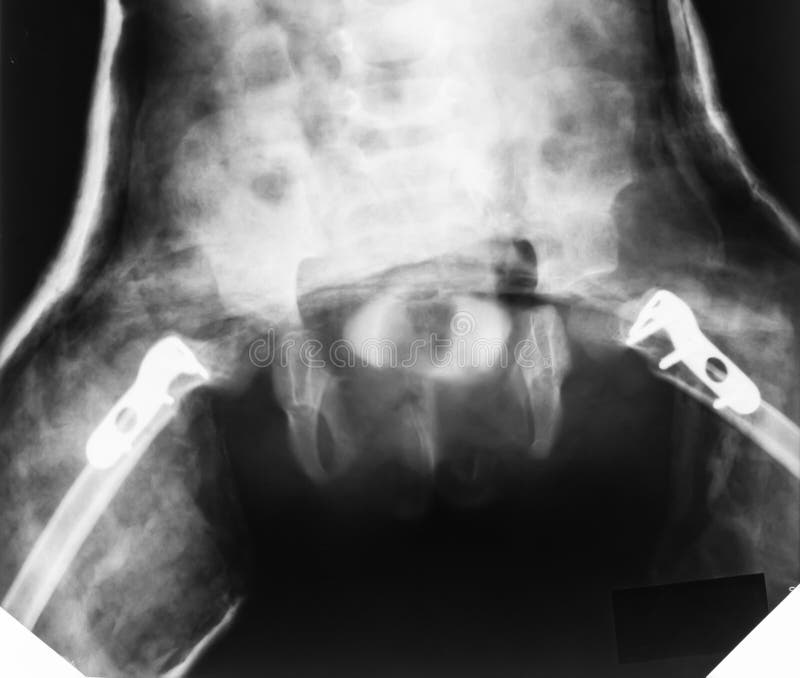 X-ray film broken bone stock photo. Image of medicine - 160022344