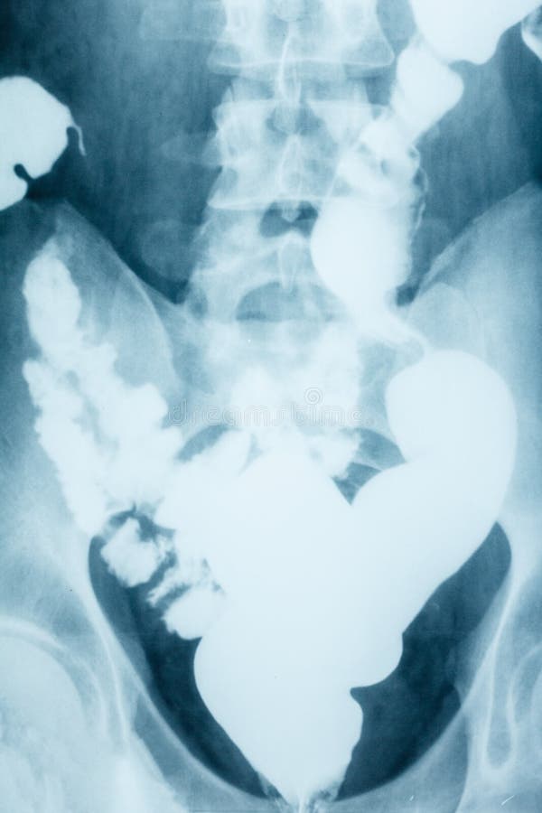 Xray/colon stock photo. Image of clinic, abdomen, injury - 49254