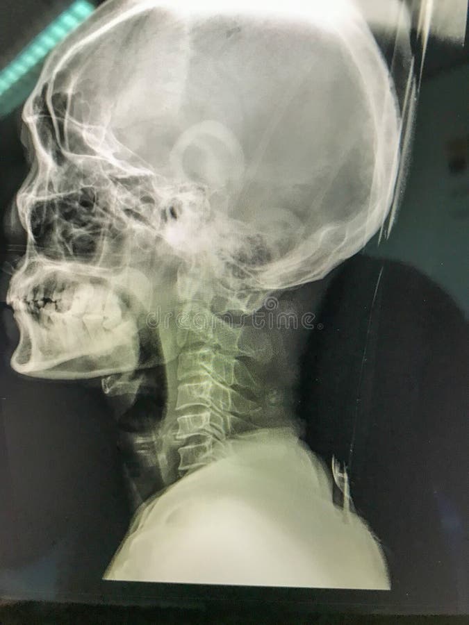 X-ray Film of Jaw Side View Stock Photo - Image of human, radiology ...
