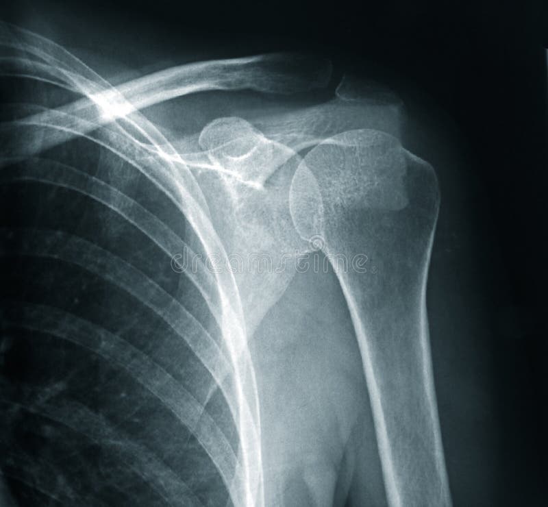 X-ray stock photo. Image of medical, illness, broken - 51590678