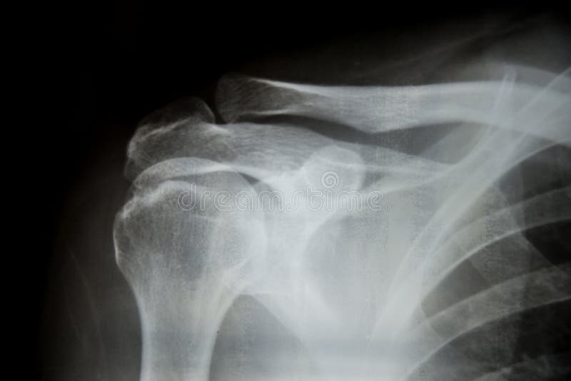 X-ray film shoulder stock photo. Image of human, body - 69875824