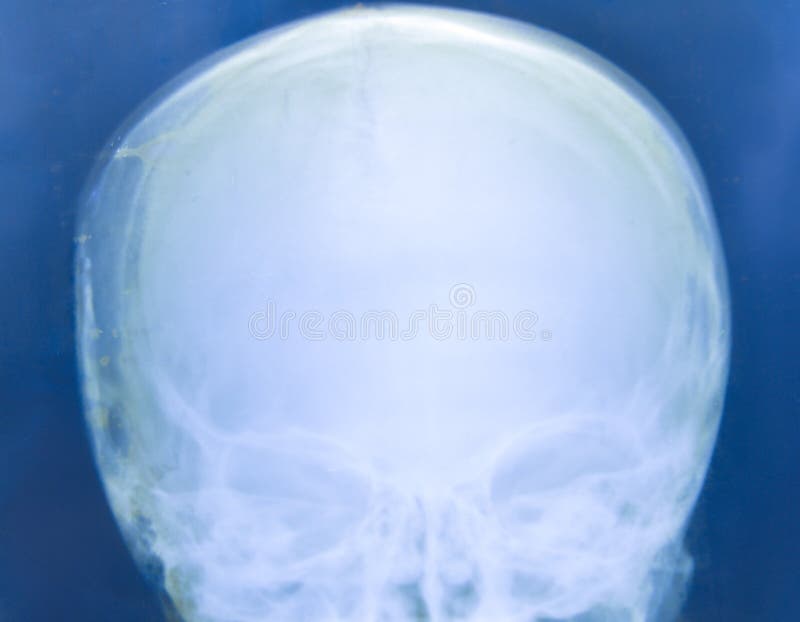 Film x-ray Skull lateral stock image. Image of skull - 91043051