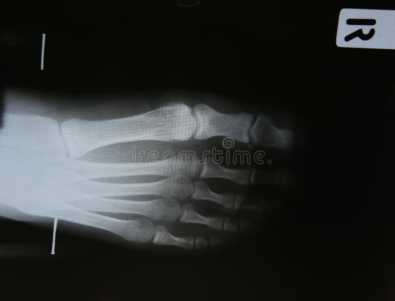 Blue Toes Sore Joint Stock Photos - Free & Royalty-Free Stock Photos ...