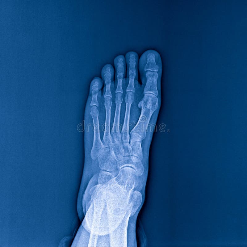 X-ray of Foot on Dark Background, Radiograph Stock Image - Image of ...