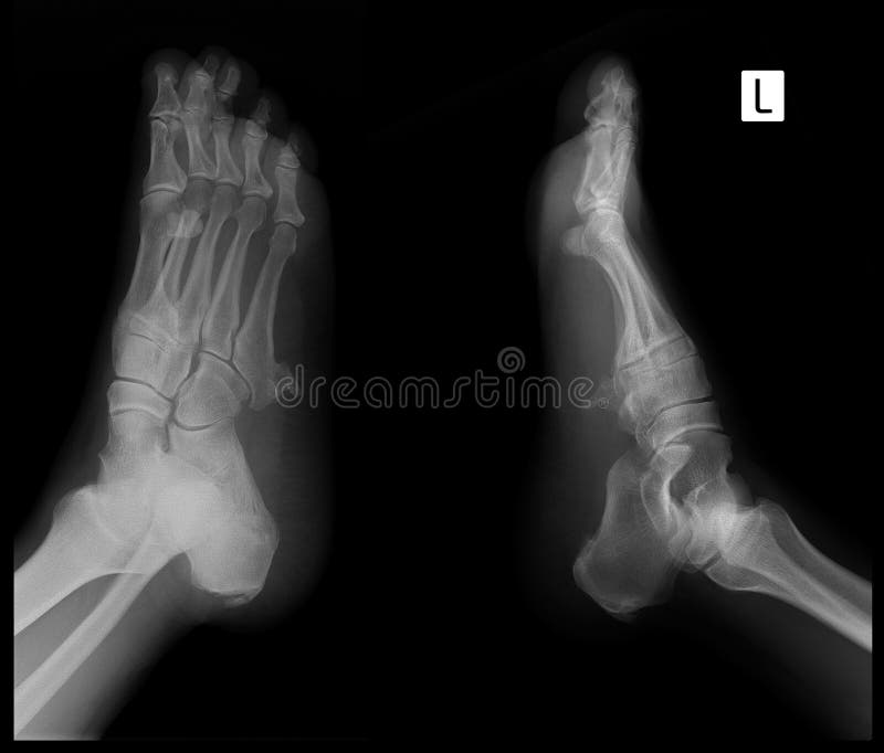 Exostosis On Top Of Foot