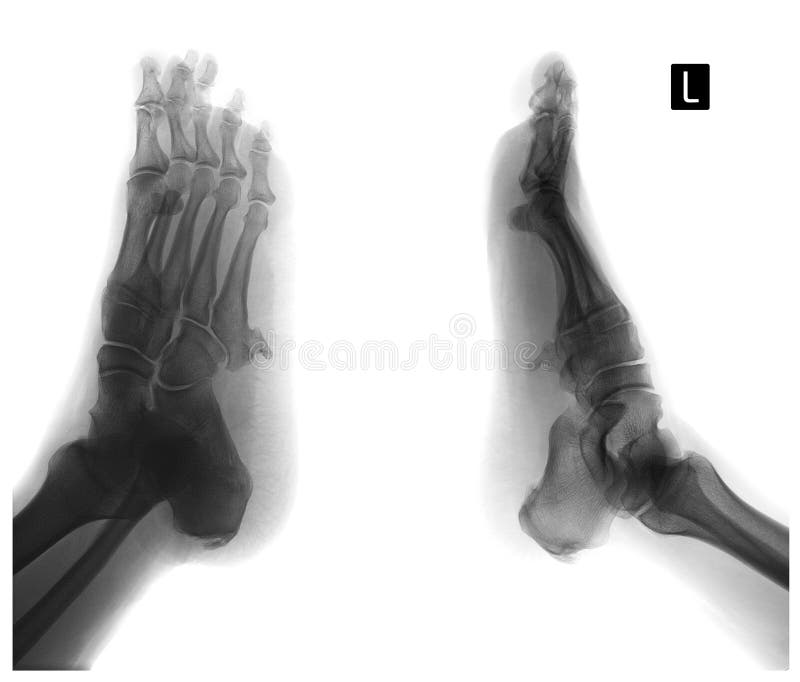 X-ray of the Foot. Exostosis of the 5th Metatarsal Bone. Negative ...