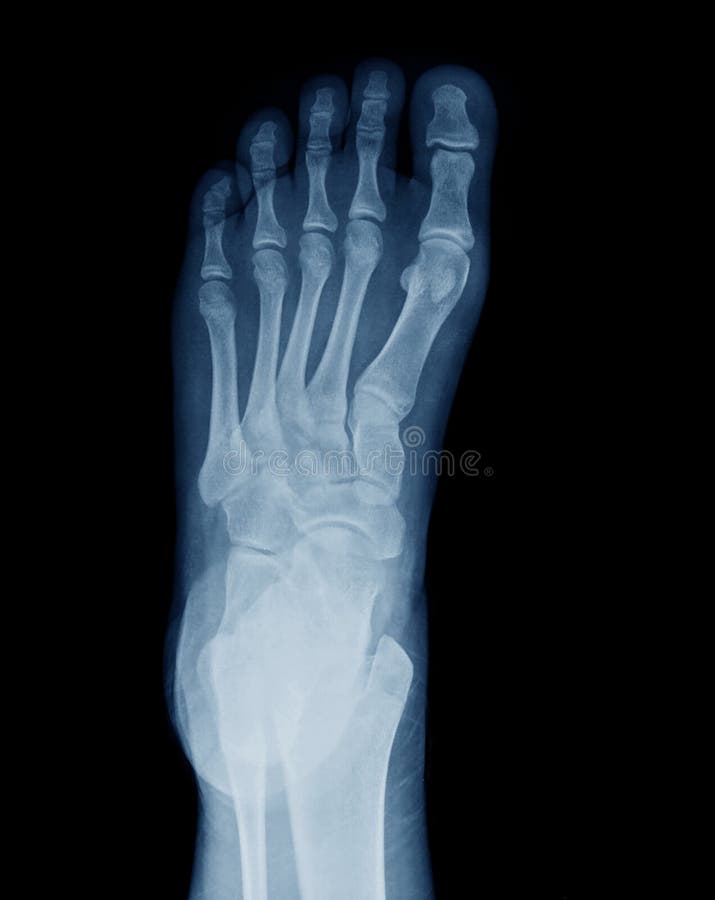 Right Foot Top Xray stock photo. Image of medical, bone - 23575678