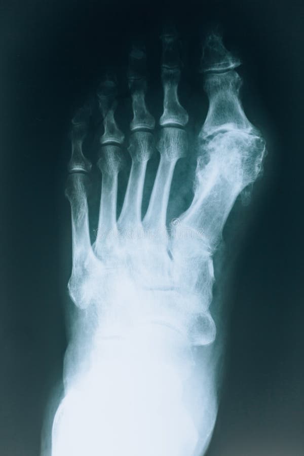 X-ray of the Foot. a Real X-ray Picture of a Sore Foot. at the Doctorâ ...