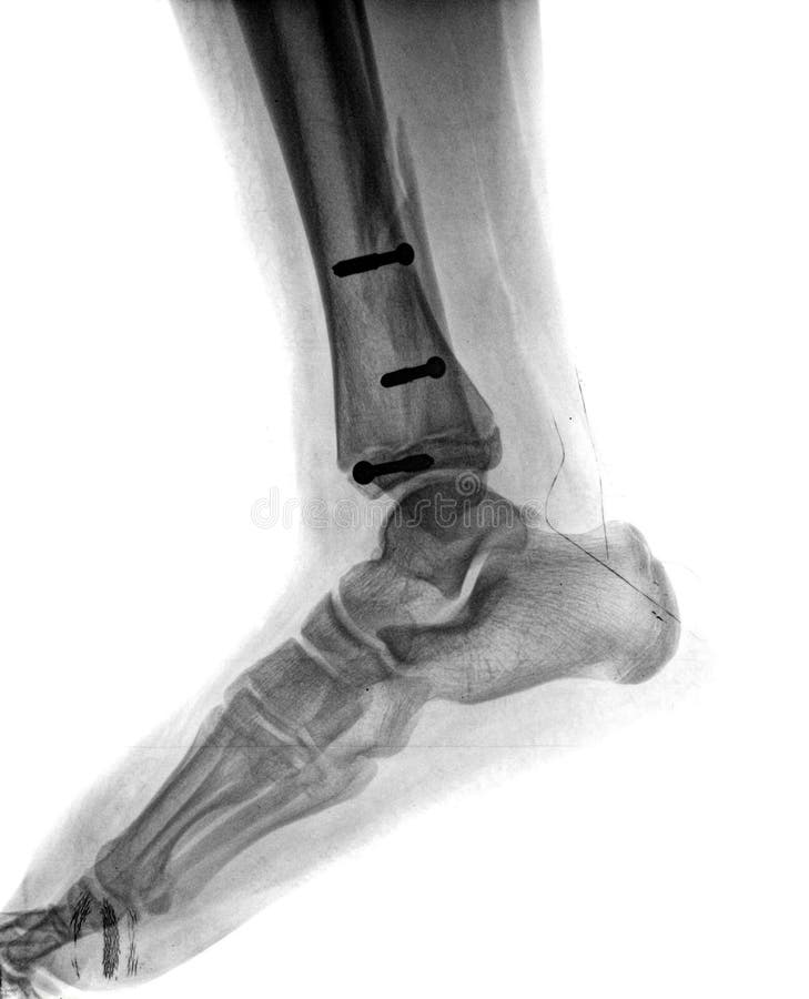134 Xray Foot Side Stock Photos - Free & Royalty-Free Stock Photos from ...