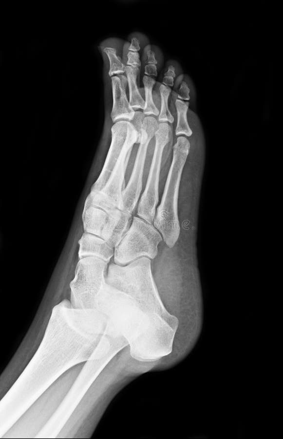 X-ray of foot stock photo. Image of hospital, doctor - 67129294