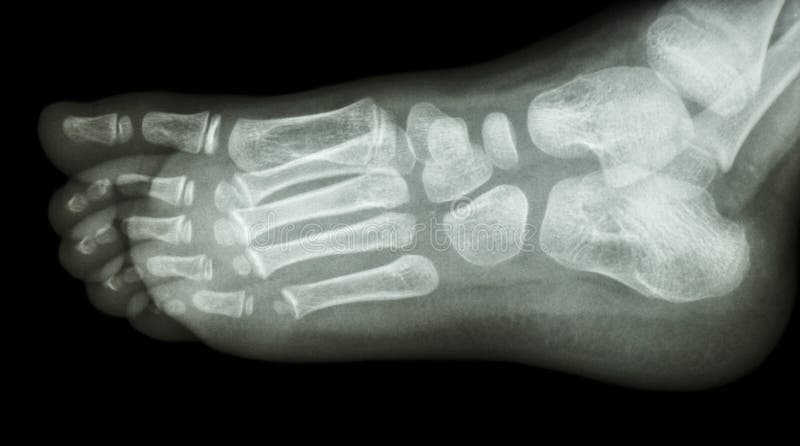 X-ray Foot Lateral : Show Normal Child S Foot Stock Photo - Image of ...