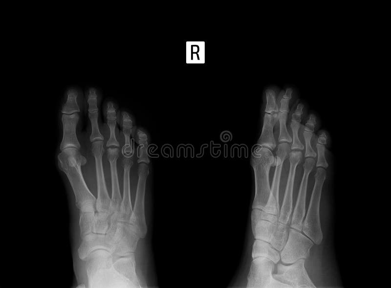 X-ray of the Foot. Exostosis of the 5th Metatarsal Bone. Negative ...