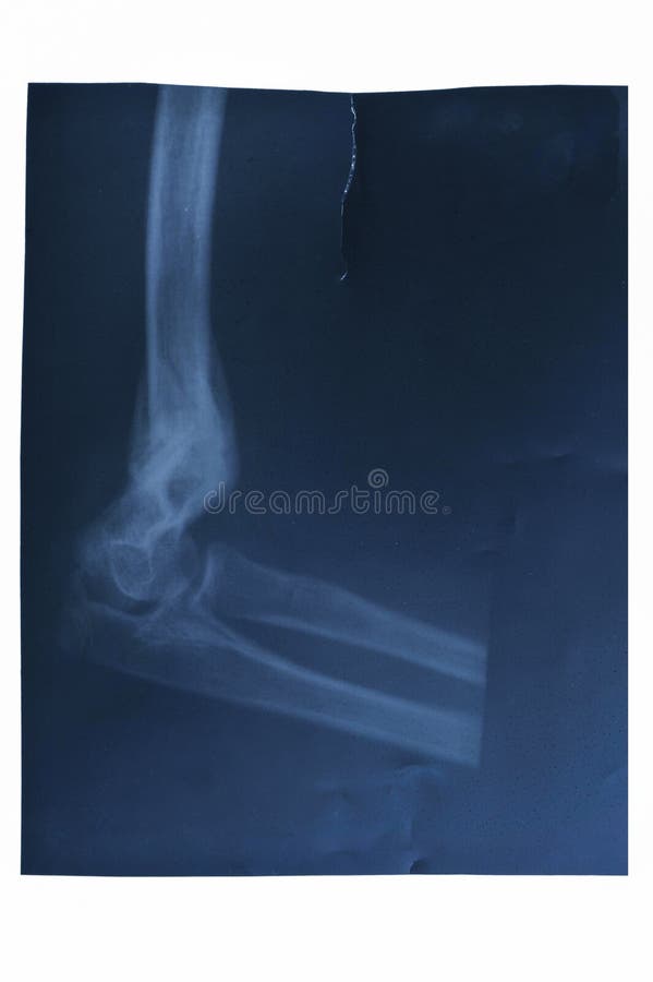 X-ray of forearm on white stock photo. Image of surgery - 137508196