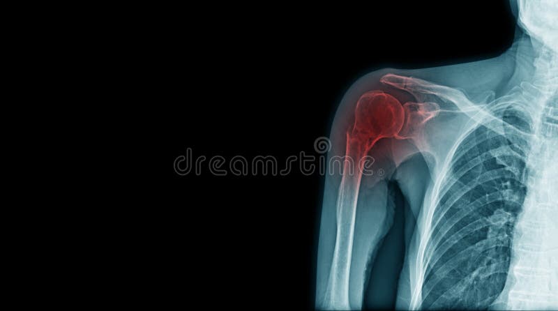 Humerus X Ray Labeled