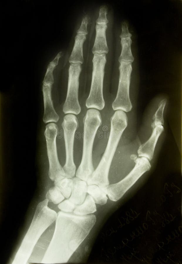 X-ray Front Picture of the Palm Stock Photo - Image of surgeon, joint ...