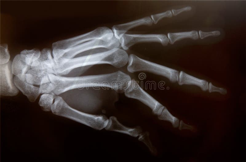 X-ray of human hand stock image. Image of arthritis, anatomy - 22870485
