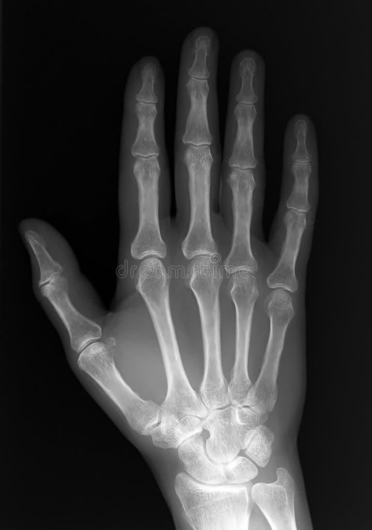 3,076 Hand Anatomy Ray Stock Photos - Free & Royalty-Free Stock Photos ...