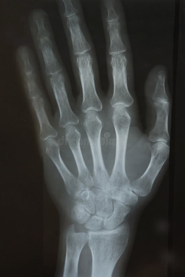 Left and Right Hand X-Ray stock image. Image of hand - 23583909