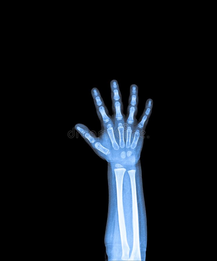 X Ray of hand. stock image. Image of forearm, imaging - 74641599