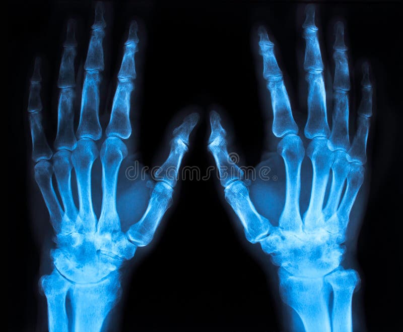 X-ray of an hand (blue) stock photo. Image of ailing - 29461132