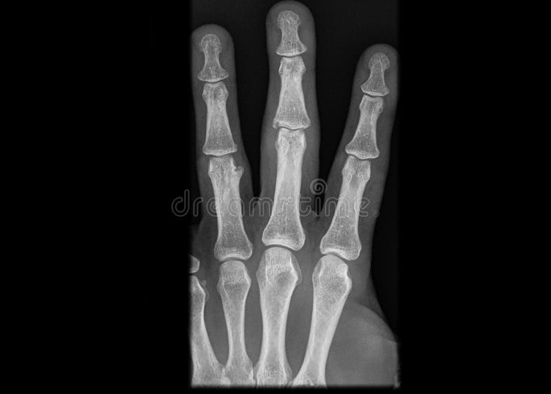 X-ray of Hand Bones. X-rayed Human Hand with Finger. Stock Image ...