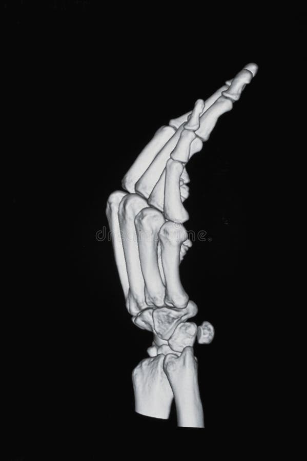 X-ray of hand stock illustration. Illustration of anatomy - 365253778