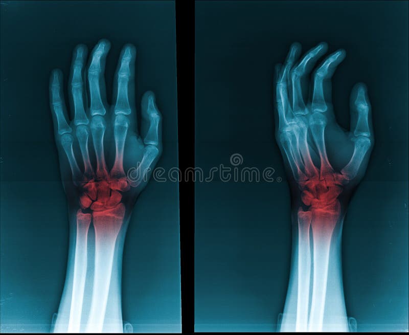 X-ray Hand and Finger, Highlighted in Red Stock Illustration ...