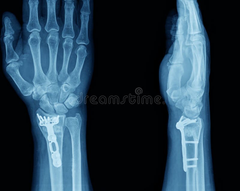X-ray of hand stock photo. Image of medicine, imaging - 47703018