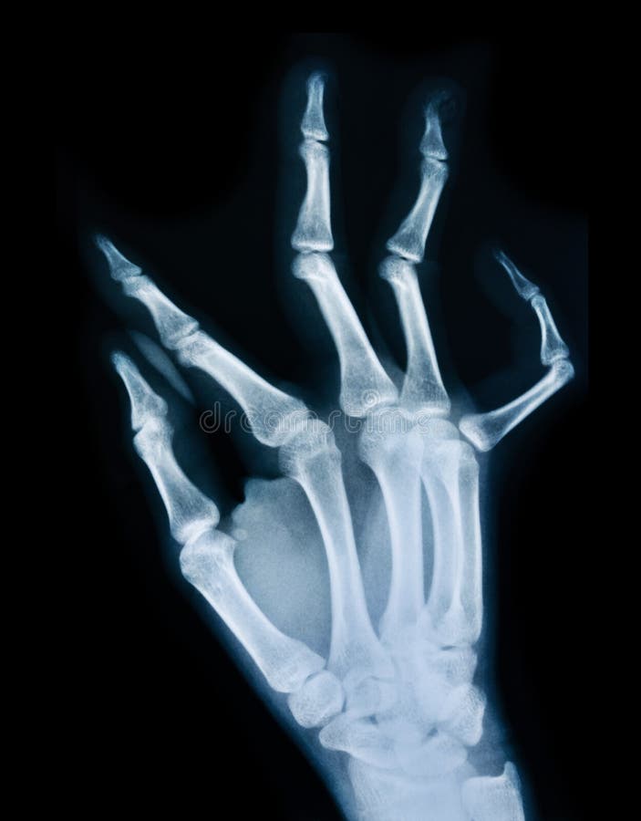 X ray of a hand. stock image. Image of person, healthcare - 97291193