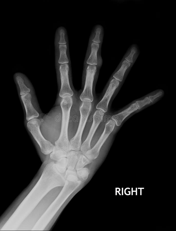 X-Ray of Hand. stock image. Image of body, condition - 67129703