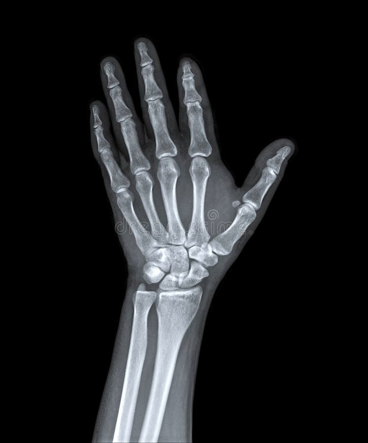 X Ray of hand. stock image. Image of check, care, rays - 91879937