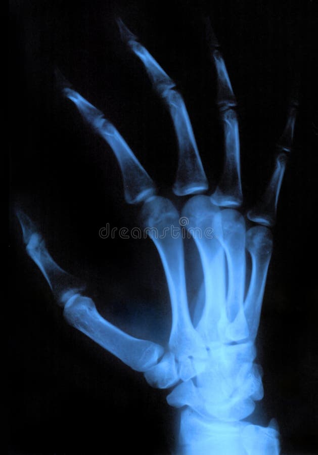 Xray Fractured Wrist Pain Stock Photos - Free & Royalty-Free Stock ...