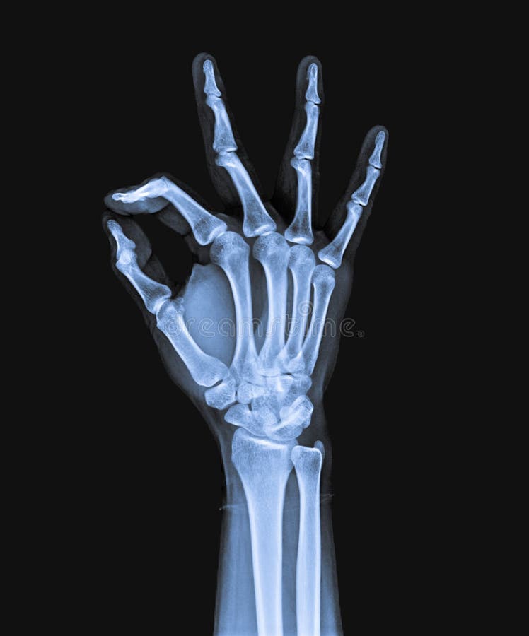 X Ray of hand stock photo. Image of rays, hand, check - 74365148
