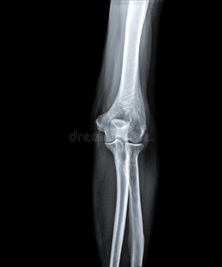 X Ray of Hand Showing Elbow Joint. Stock Photo - Image of fingers, bony ...