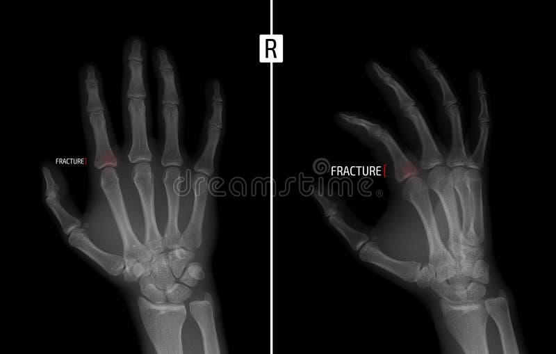 X-ray of the Hand. Shows the Fracture of the Base of the Proximal ...