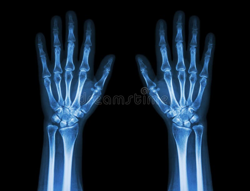 Normal Hand X Ray Normal Hands On X Ray X Rays Case Studies CTisus