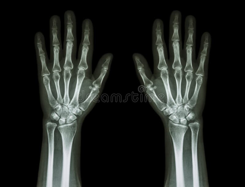 X-Ray Hands ( Front View ) : Normal Human Hands Stock Image - Image of ...
