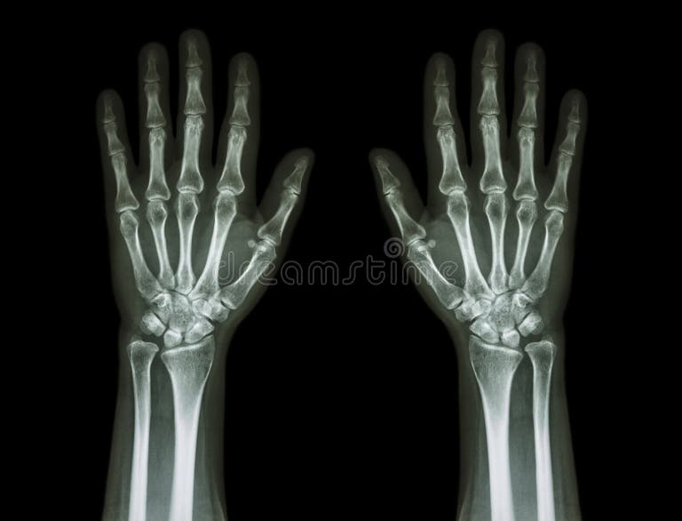 X-Ray Hands ( Front View ) : Normal Human Hands Stock Image - Image of ...