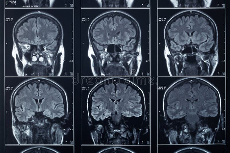 X-ray Head and Brain, Medical Exam Stock Photo - Image of head, broken ...