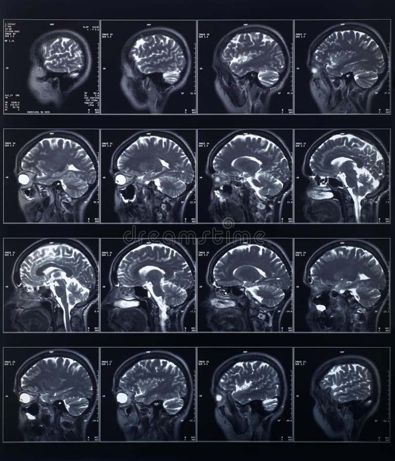 X-ray Head and Brain, Medical Exam Stock Image - Image of radiation ...