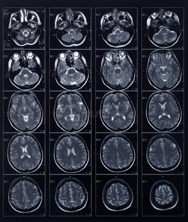X-ray Head and Brain Radiography Stock Image - Image of diagnostic ...