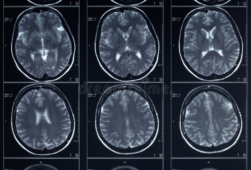 X-ray Head and Brain Radiography Stock Image - Image of diagnostic ...