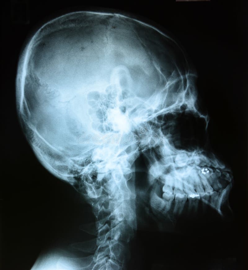 X Ray Head Neck Stock Photos - Download 811 Royalty Free Photos